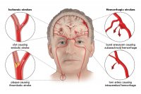 Stroke Information