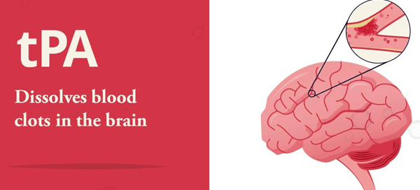 Stroke Treatment Archives - Stroke Awareness Foundation